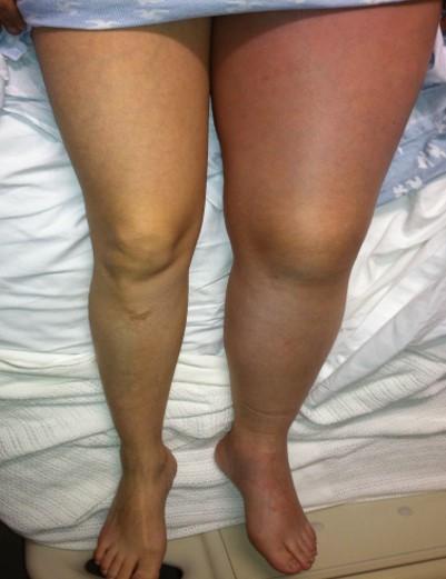 Leg Pain In Seniors 6 Causes Diagnosis And Treatment leg-pain-in-seniors-6-causes-diagnosis-and-treatment